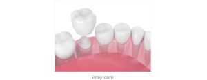Inlay Onlay et Inlay core : c'est quoi, quel remboursement