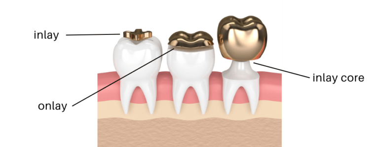 Inlay Onlay et Inlay core : c'est quoi, quel remboursement