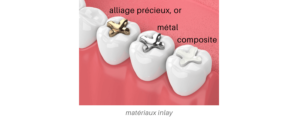 Inlay Onlay et Inlay core : c'est quoi, quel remboursement