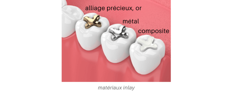 Inlay Onlay et Inlay core : c'est quoi, quel remboursement